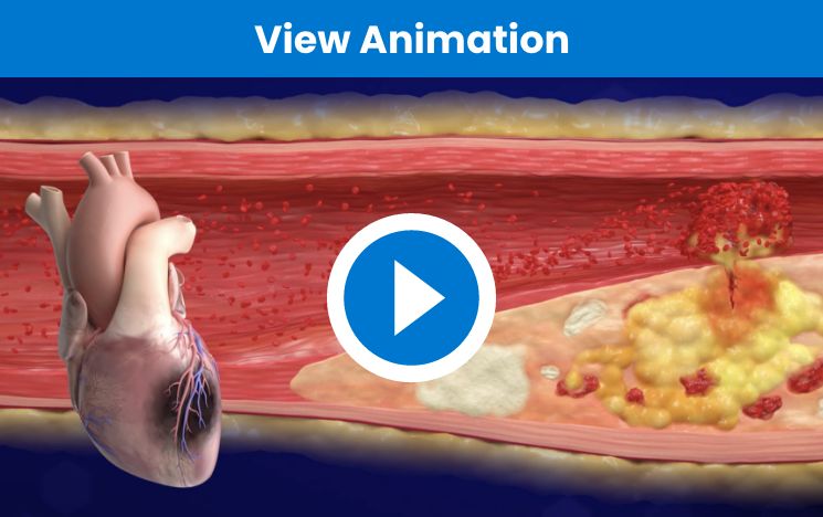 Arterial Analysis Software | Elucid