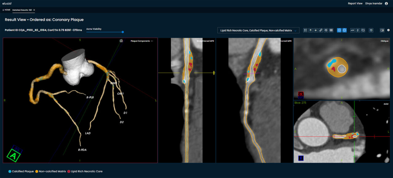 Elucid | Visualize Lesion-level Plaque Composition